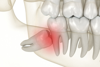 Effective Relief for Wisdom Tooth Pain: Causes and Symptoms